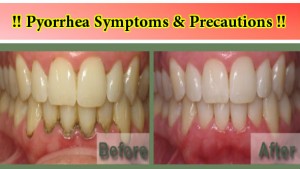 Pyorrhea: Janiye Daant Rog ke Lakshan aur Savdhani