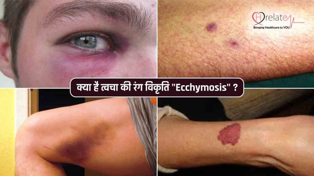 Ecchymosis: जानिए एकाइमोसिस के लक्षण, कारण और बचाव में इस्तेमाल होने ...